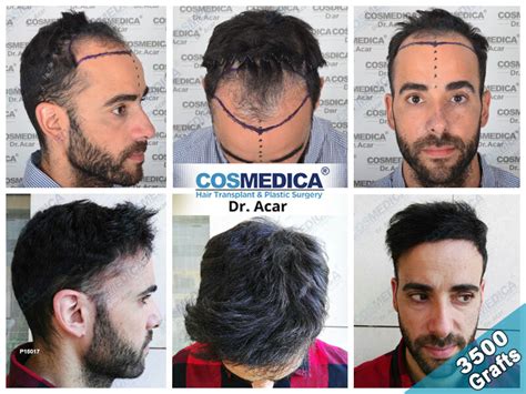 Trapianto Capelli Prima E Dopo Clinica Cosmedica Dr Acar