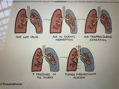 Pneumothorax Flashcards Quizlet