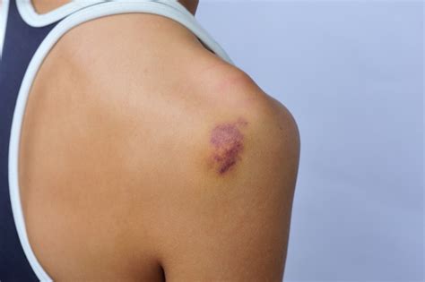17 Signs Your Bug Bite Is Something Serious — Best Life