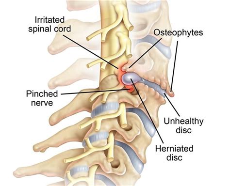 Cervical Disc Herniation Slip Disc