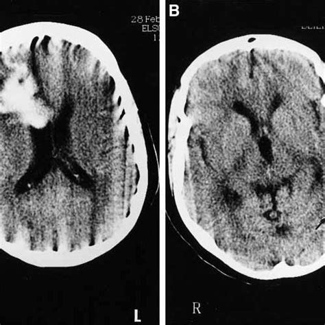 A CT Scan Of The Brain Showing An Intracerebral Hemorrhage In The