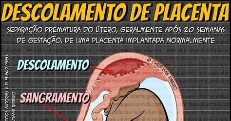 Descolamento Prematuro Da Placenta Enfermagem Ilustrada