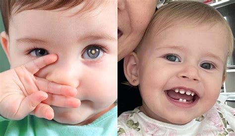 O Que O Retinoblastoma C Ncer Que Afeta A Filha De Tiago Leifert