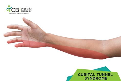 Top Exercises For Cubital Tunnel Syndrome Webp