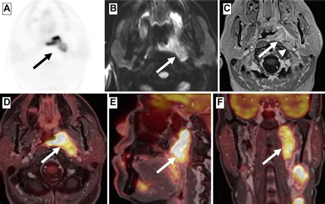 PET CT And PET MR Imaging Of The Post Treatment Head And Neck