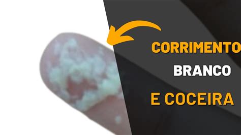 Corrimento Branco Coceira Corrimento Branco Pastoso Dra Roberta