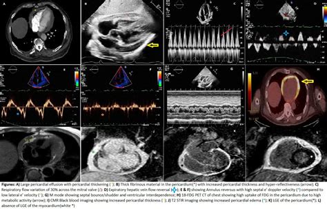 USING MULTI MODALITY IMAGING TO DIFFERENTIATE TUBERCULOUS PERICARDITIS