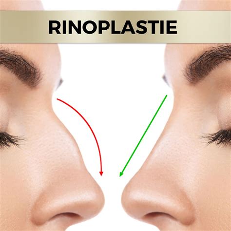 Rinoplastia operația de deviație de sept moft sau necesitate