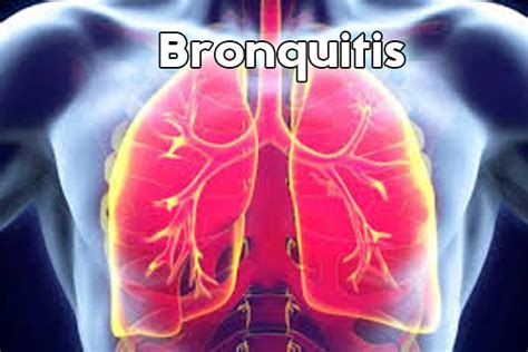 Bronquitis Clinica Hispana Harrisburg