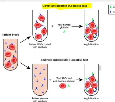 Hemolytic Anemia Flashcards Quizlet