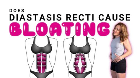 Does Diastasis Recti Cause Bloating Get Mom Strong