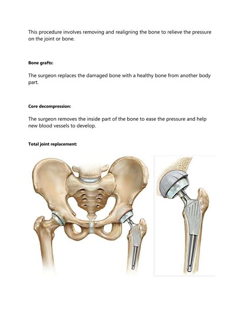 PPT Everything You Need To Know About Avascular Necrosis PowerPoint