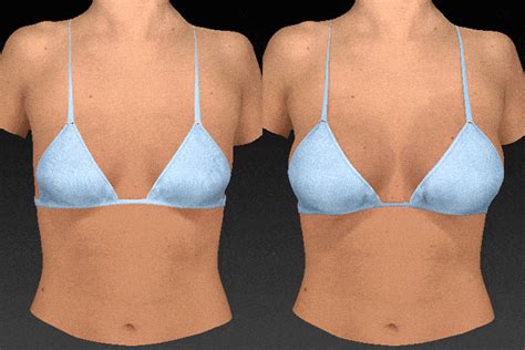 Breast Surgery 3 D Imaging For Toronto Brampton Mississauga