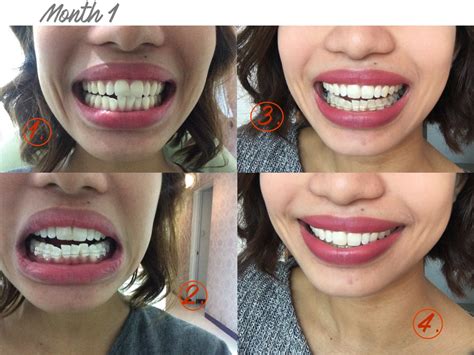Getting The Perfect Smile Molar Tooth Extraction My Fashion Smile