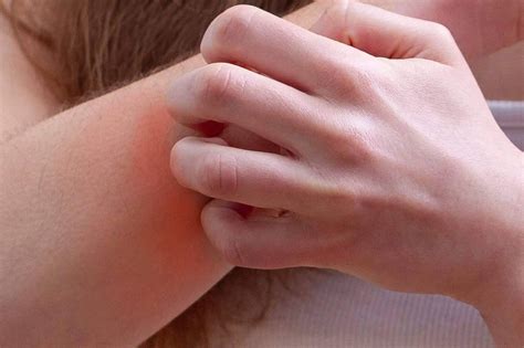 Atopowe zapalenie skóry przyczyny objawy diagnostyka Nowa Genetyka