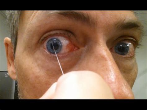 Conjunctivitis Eye Discharge Wait For It YouTube