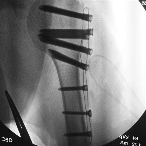 Medical Apparatus Imaging Guide Fracture Fixation
