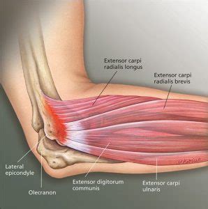 Elbow Hyperextension Injury And TFCC Tear Ulnar Side Wrist Pain