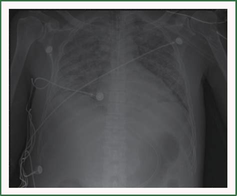 Figure 1 From Acute Respiratory Distress Syndrome With Miliary