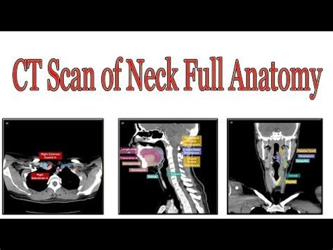 CT Scan Of Neck Axial Full Anatomy YouTube In 2024 Ct Scan Anatomy