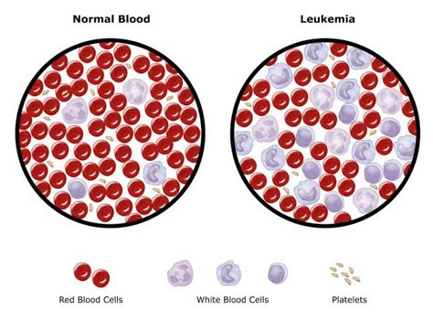 Blood Cancer HealthGist Net