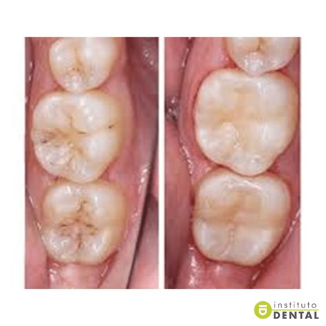 Qué es un empaste dental Instituto Dental Bravo Corpas