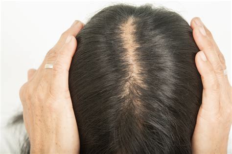 Why Female Pattern Baldness Is Different Specialized Techniques