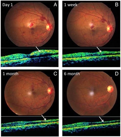 Combined Central Retinal Vein And Branch Retinal Artery Occlusion In