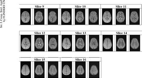 figure 1 from support vector machine based automatic classification of human brain using mr