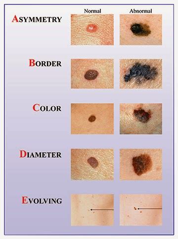 Melanoma A Mole Gone Bad The Eye Associates