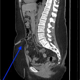 CT Scan Axial View Of The Right Upper Quadrant Incisional Hernia Blue