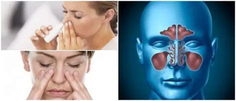 Sinusitis Aguda Causas Síntomas Diagnóstico Tratamiento y