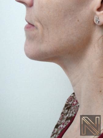 Ultherapy A Non Invasive Cosmetic Procedure To Lift And Tighten Skin