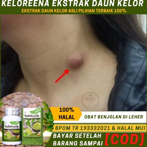 Jual Obat Menghilangkan Benjolan Di Leher Sebelah Kanan Dan Kiri