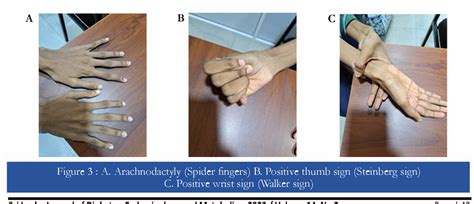 Figure From A Case Report On A Rare Combination Of Gitelman Syndrome