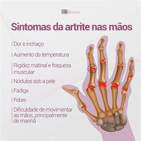Sintomas da artrite nas mãos Artrite Reumatoide