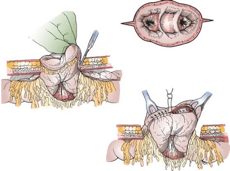 loop colostomy and colostomy closure basicmedical key