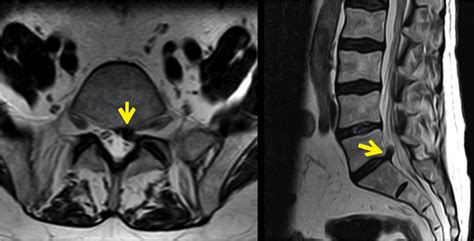 Thecal Sac Effacement Definition Spine Info