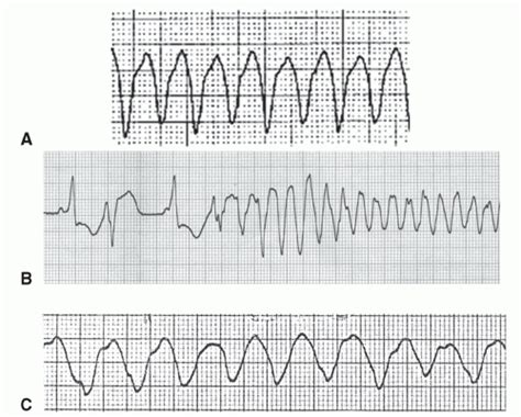 Monomorphic Vs Polymorphic Ventricular Tachycardia