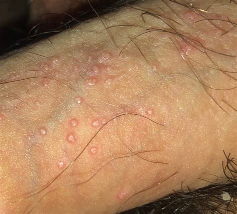 Molluscum Contagiosum On The Penis Telegraph