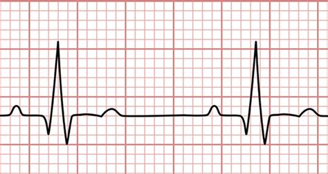 Sinus Rhythm
