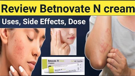 Betnovate N Skin Cream Review Betnovate Betnovate N Lagane Se Kya