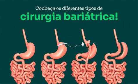 Quais são os diferentes tipos de cirurgia bariátrica Qual o melhor