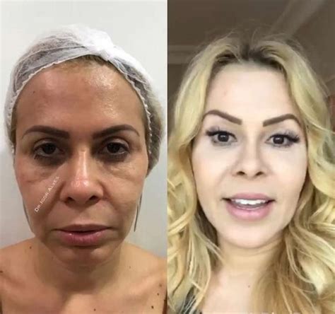 Harmonização Facial veja o antes e depois das famosas que fizeram We