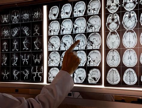 Implementan técnicas avanzadas de neuroimágenes y estimulación cerebral