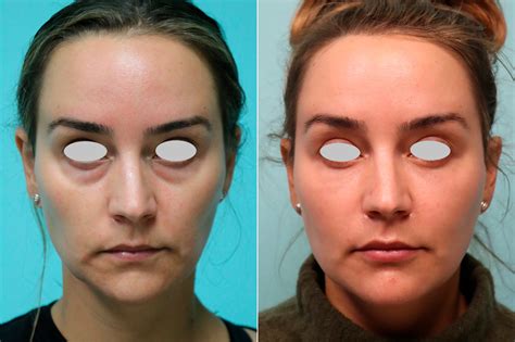 Blepharoplasty Fat Transfer Tear Trough Under Eye Injections Photos