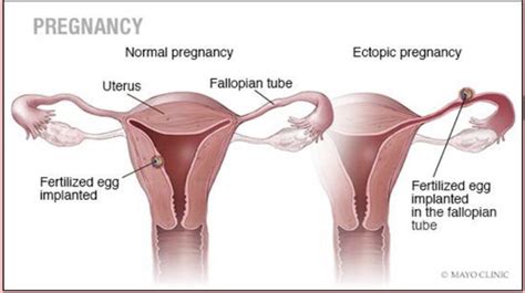 Ost Lecture Ectopic Pregnancy Flashcards Quizlet