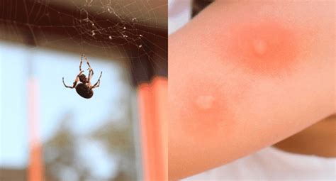 Cómo identificar la picadura de una araña y cómo tratarla con remedios