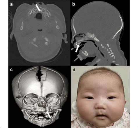 Facial Computed Tomography Ct And Photograph Of The Patient A Axial