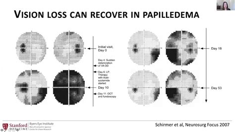 Clinical Presentation And History Mechanism Of Vision Loss In